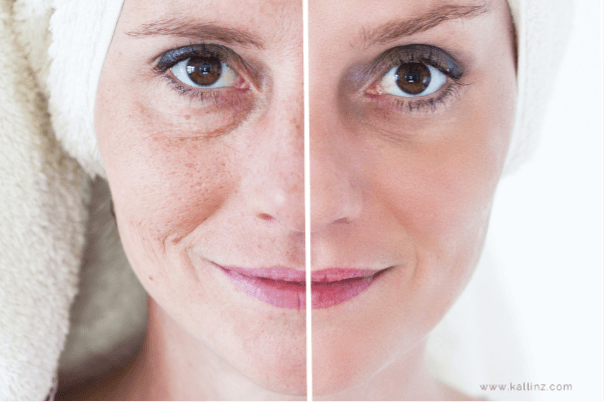 How to look 10 years younger without Botox or Surgery? – Kallinz